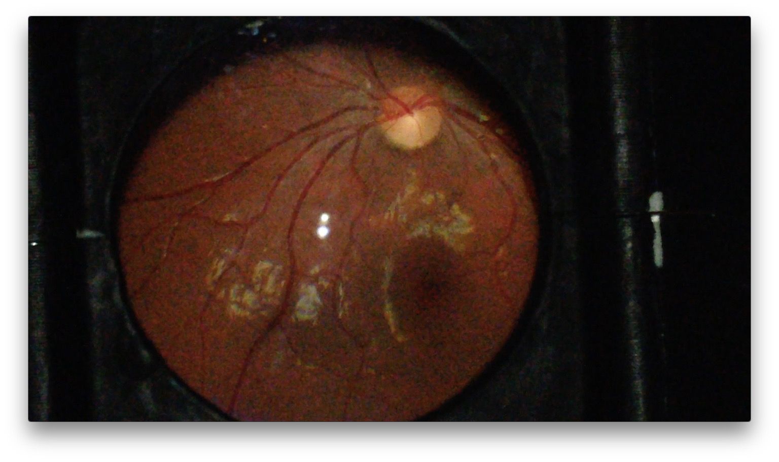 Smartphone Fundus Camera : 8 Steps (with Pictures) - Instructables