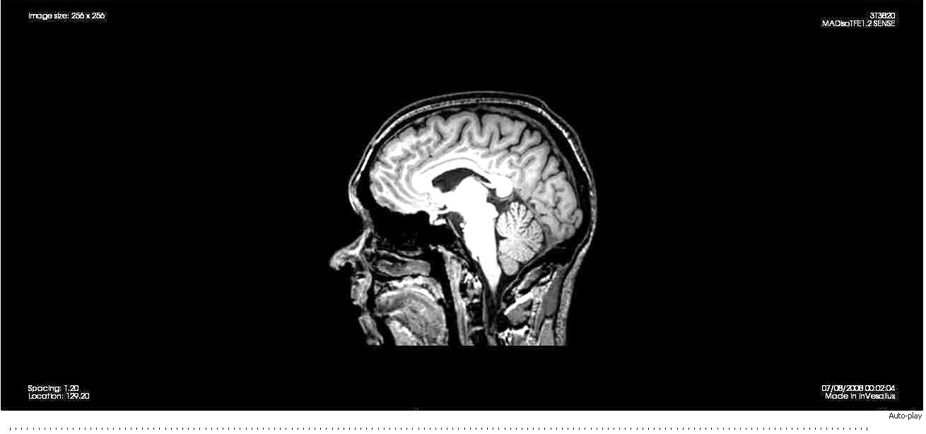 Edible Chocolate Brain From MRI Scan : 9 Steps (with Pictures ...