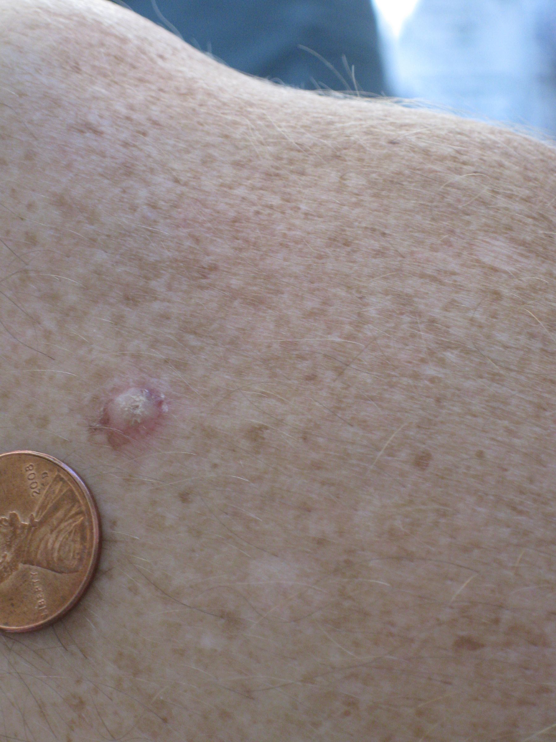 Electronic Wart Removal - No Blood! Little Pain. : 6 Steps - Instructables