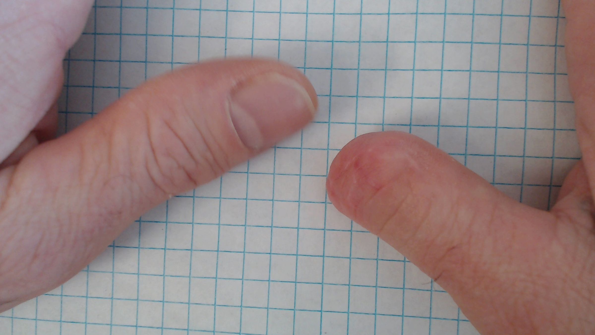 Thumb Prosthesis : 12 Steps (with Pictures) - Instructables