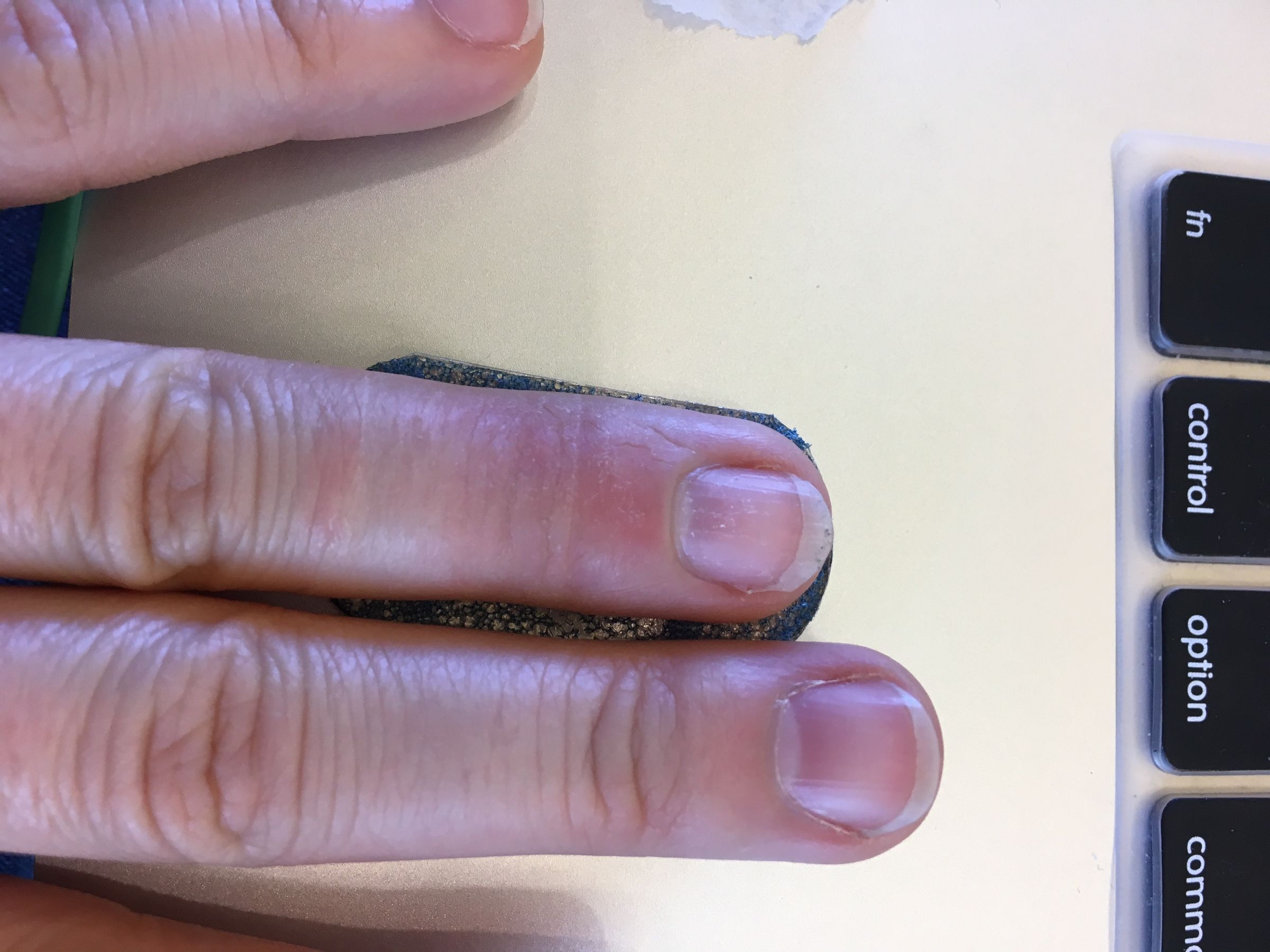 Custom 3D Printed Finger Splint : 3 Steps (with Pictures) - Instructables