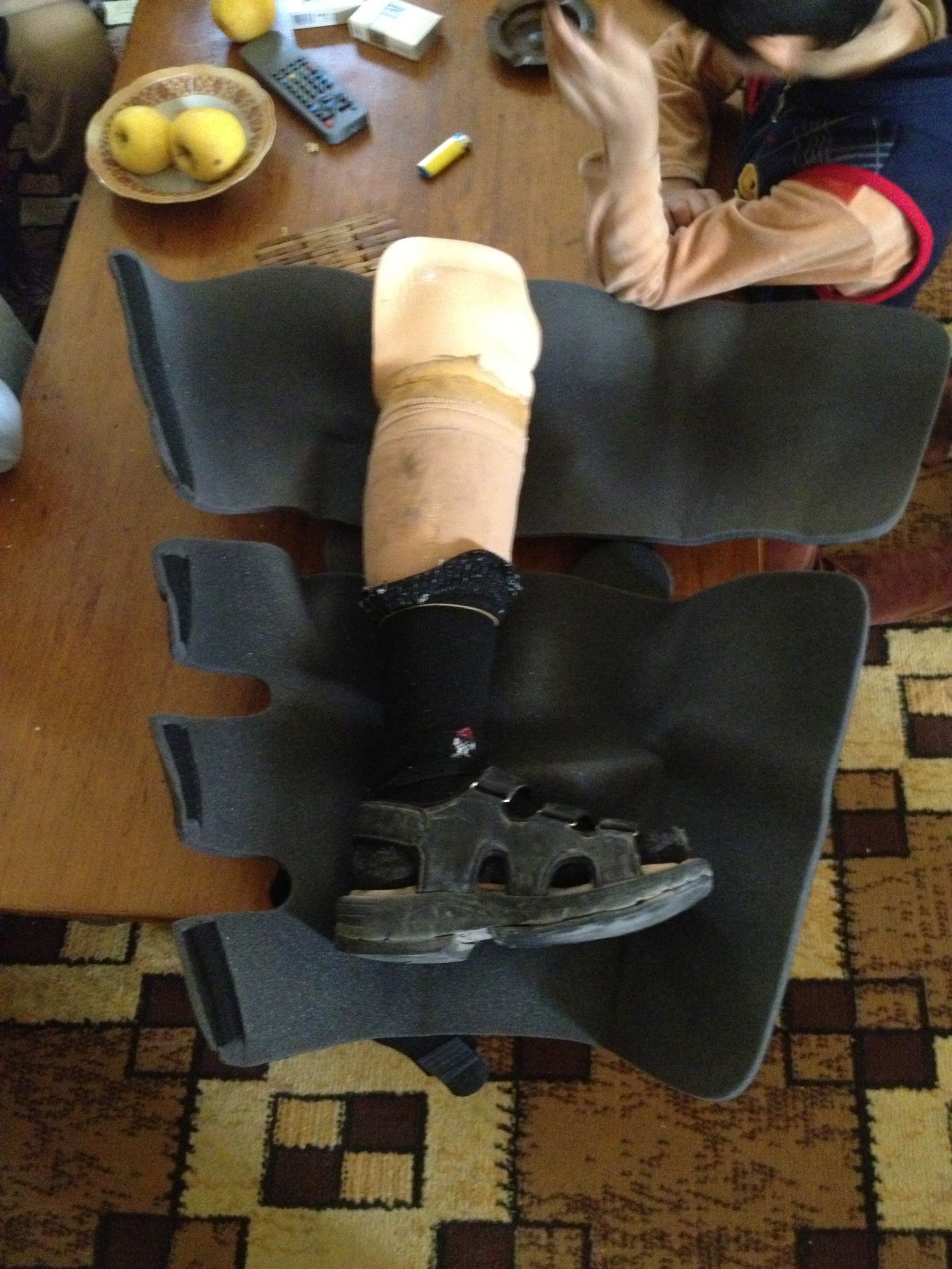 Prosthetics Modification for Pain Relief of Pressure Points (with ...