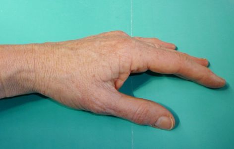 Get Rid of a Ganglion- Painlessly : 3 Steps (with Pictures) - Instructables