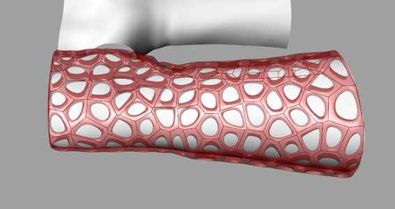 How to Design Custom, 3D Printable Braces for Arm Injury : 8 Steps ...