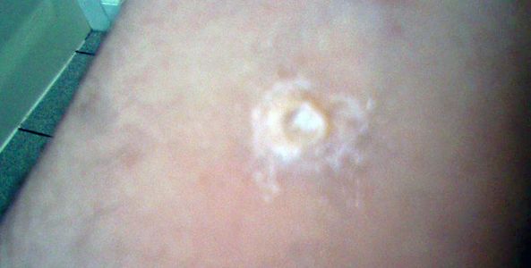 Realistic Vampire Bite : 5 Steps (with Pictures) - Instructables