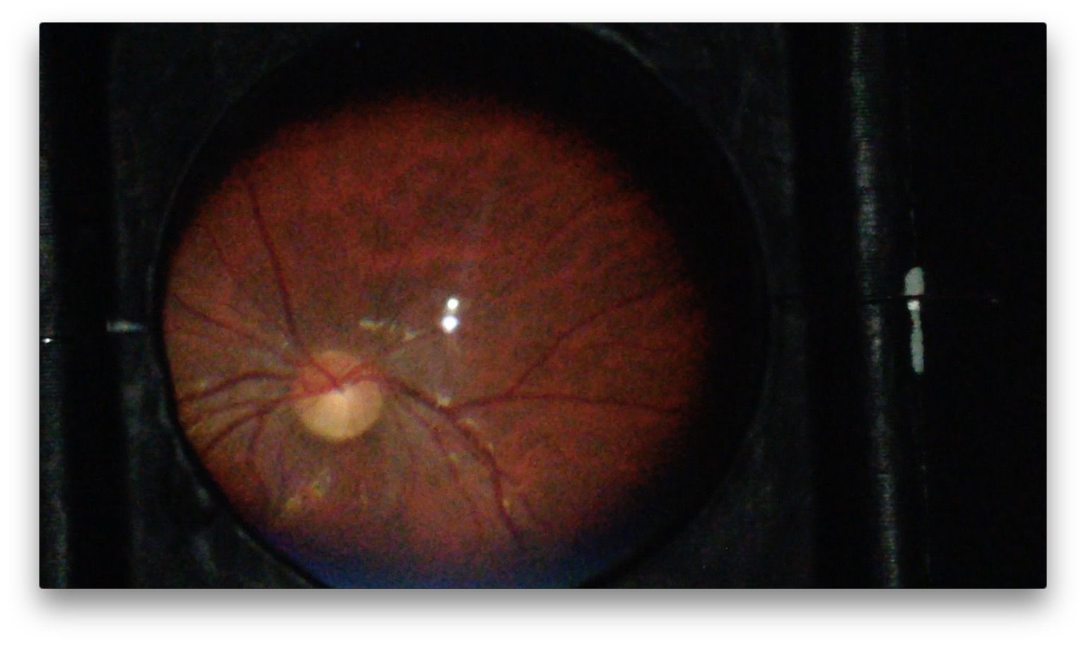 Smartphone Fundus Camera : 8 Steps (with Pictures) - Instructables