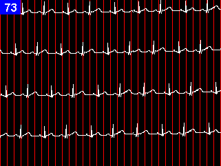 ECG Display With Arduino : 13 Steps (with Pictures) - Instructables