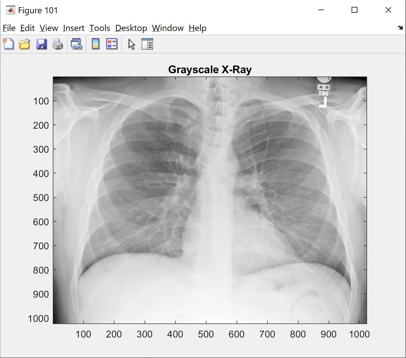 MatLab Lung Segmentation : 5 Steps - Instructables