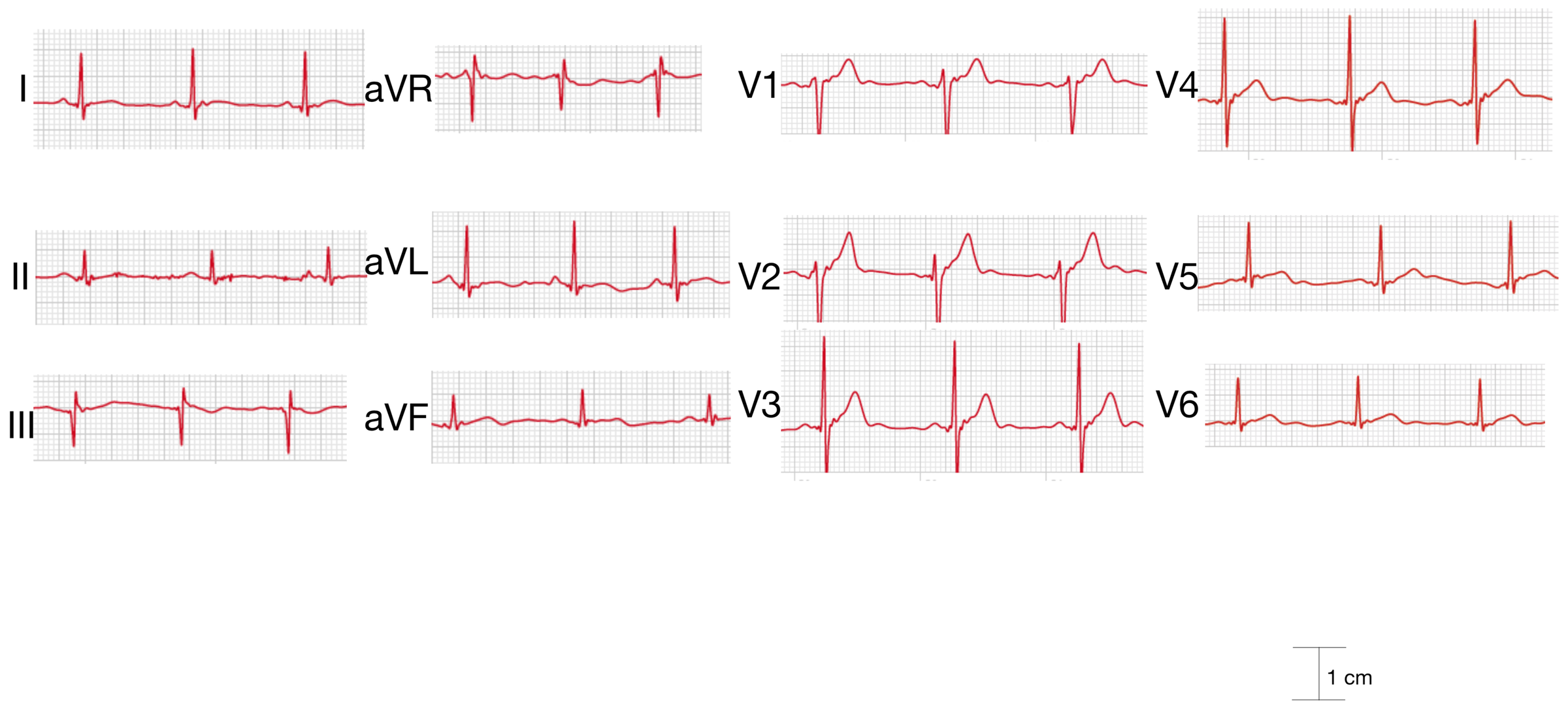 Simulate a 12-Lead ECG With Apple Watch Series 4 or Later : 14 Steps ...