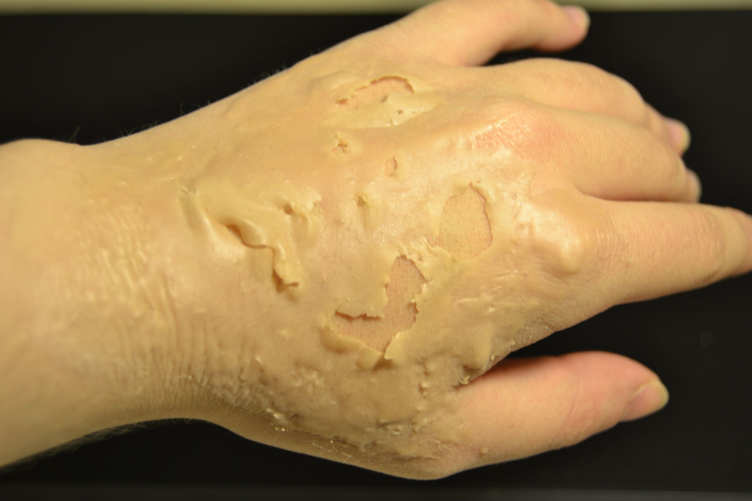 Fake Burned Skin : 4 Steps (with Pictures) - Instructables