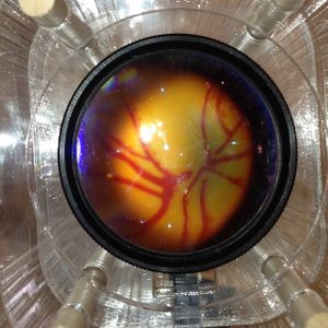 Smartphone Fundus Camera : 8 Steps (with Pictures) - Instructables