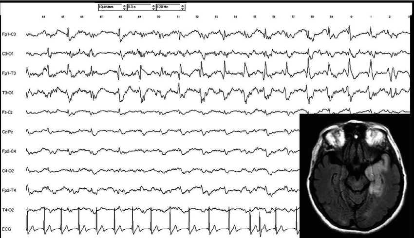 DIY EEG (and ECG) Circuit : 12 Steps (with Pictures) - Instructables
