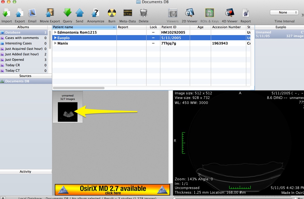 How to Convert Medical Scan Data Into a 3D Printable Model (also ...