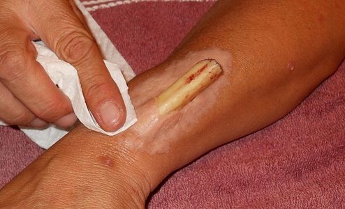 Make a Realistic Makeup Compound Fracture : 10 Steps (with Pictures ...